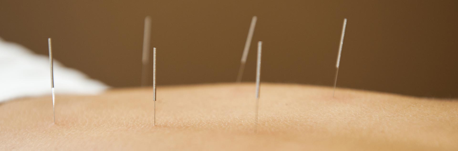 What is Acupuncture? - Fit4 Physio